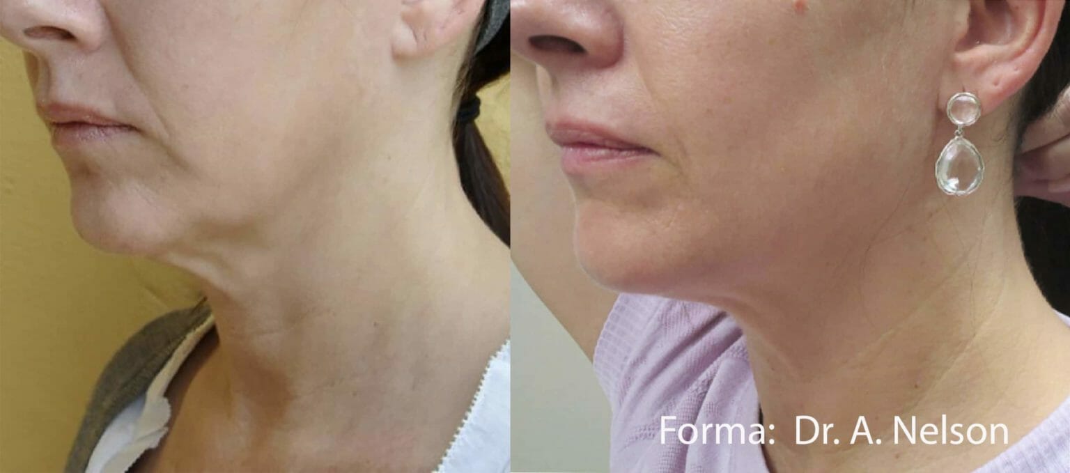 Forma Facial Skin Tightening | Chicago Aesthetics Med Spa