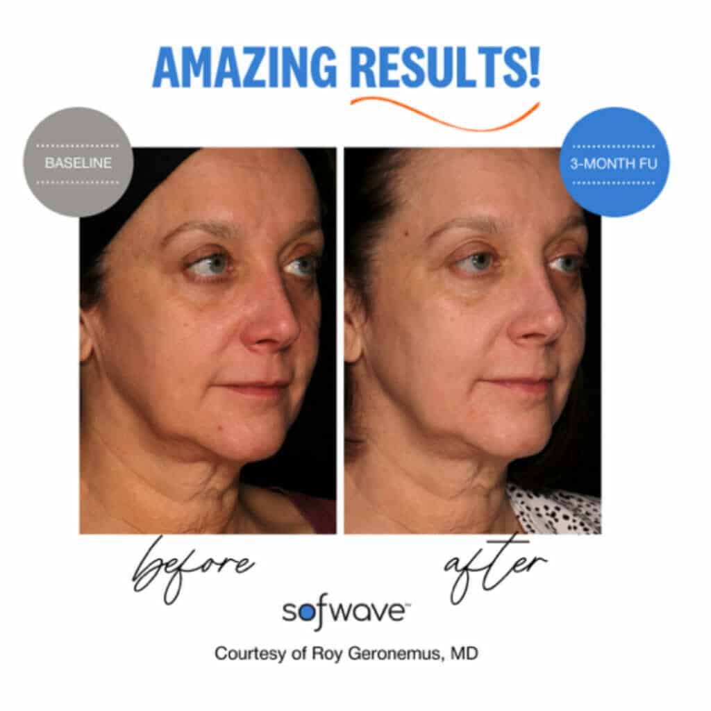 Sofwave Lifts & Tightens Skin | Chicago Aesthetics