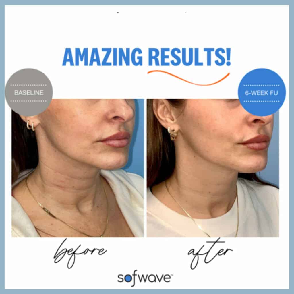 Sofwave Lifts & Tightens Skin | Chicago Aesthetics