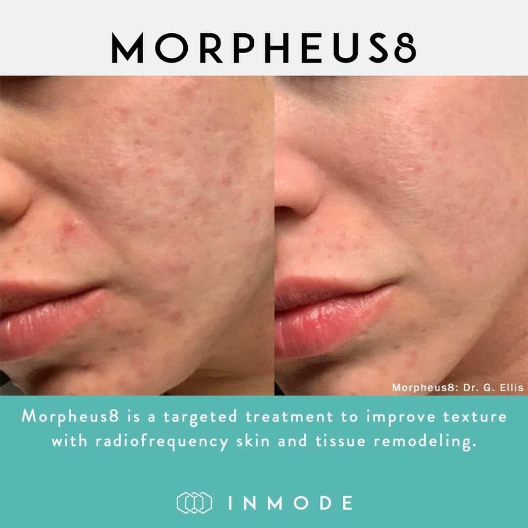 What Is Morpheus8 Treatment | Chicago Aesthetic Surgery & Med Spa