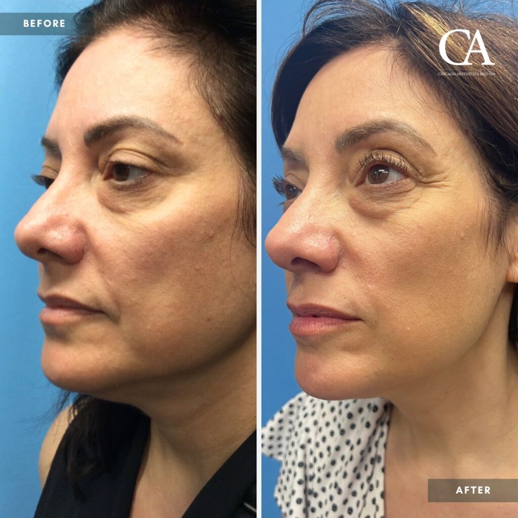 Sofwave Skin Lifting Treatment | Chicago Aesthetics Med Spa