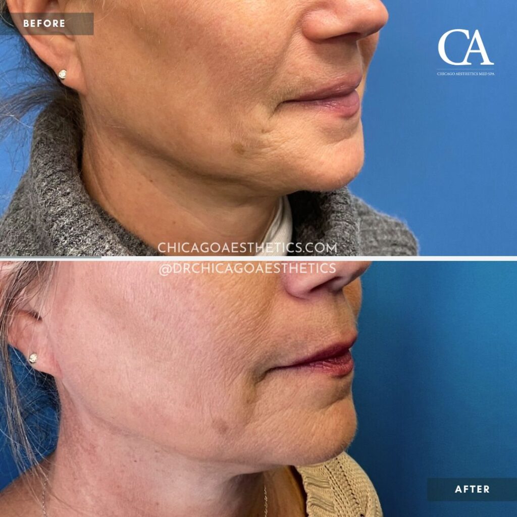 Sofwave Before After Photos | Chicago Aesthetic Surgery & Med Spa