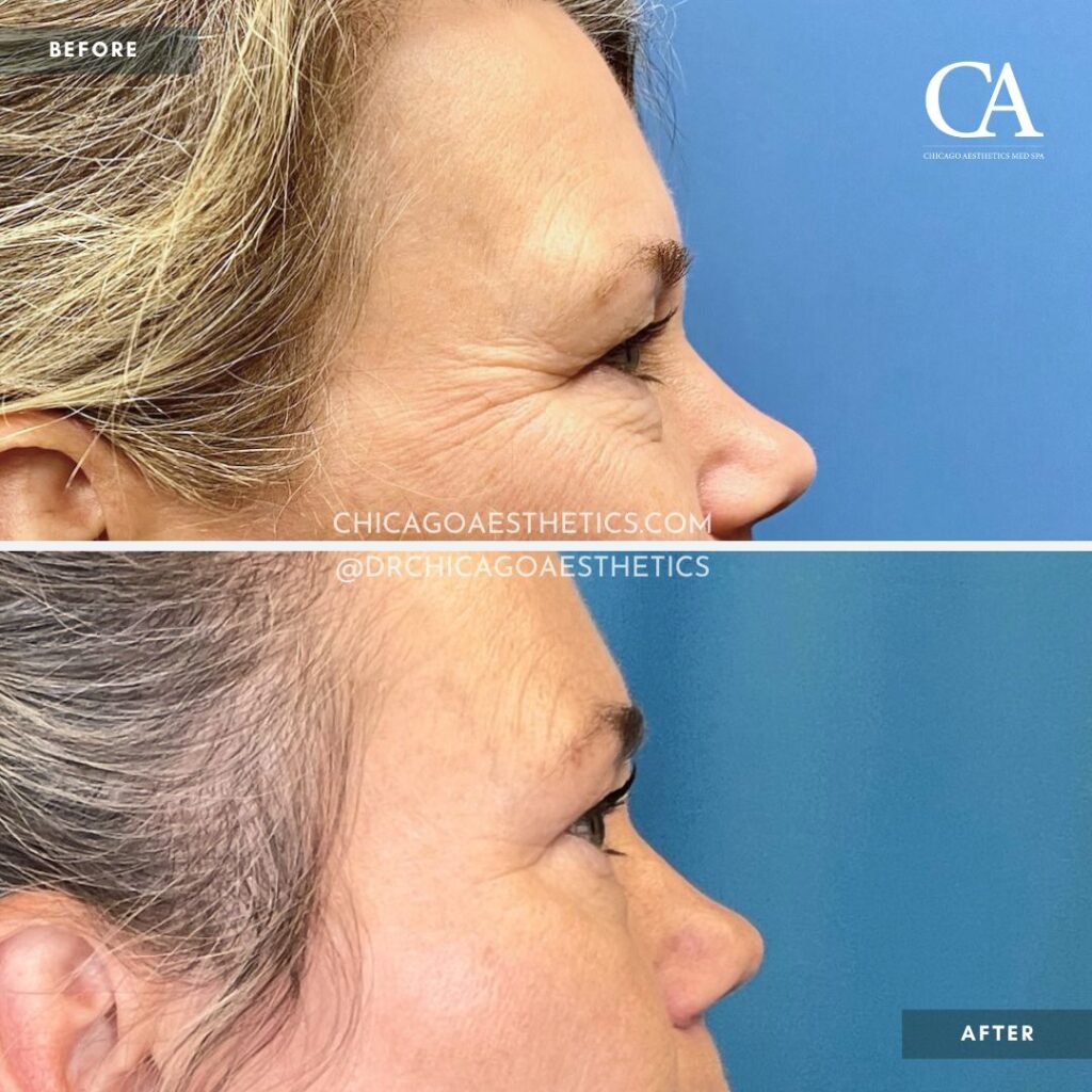 Sofwave Before After Photos | Chicago Aesthetic Surgery & Med Spa