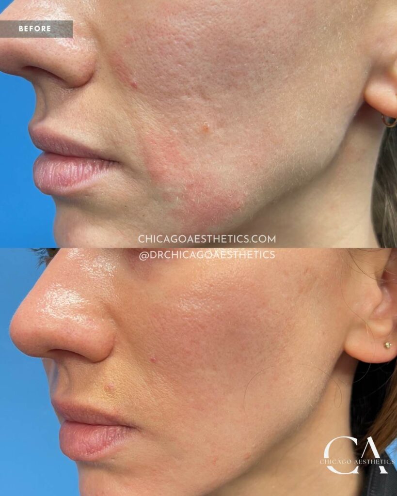 Morpheus8 Before After | Chicago Aesthetics