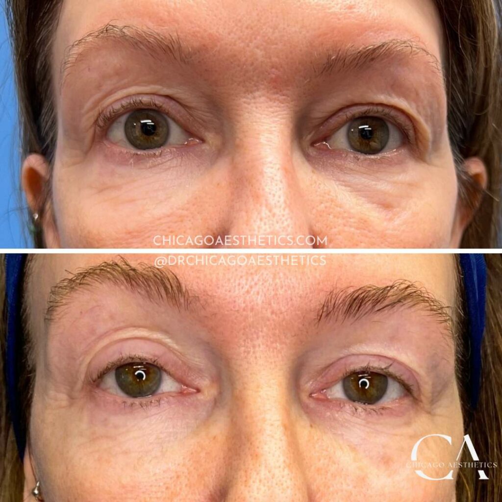 Sofwave Before After Photos | Chicago Aesthetic Surgery & Med Spa