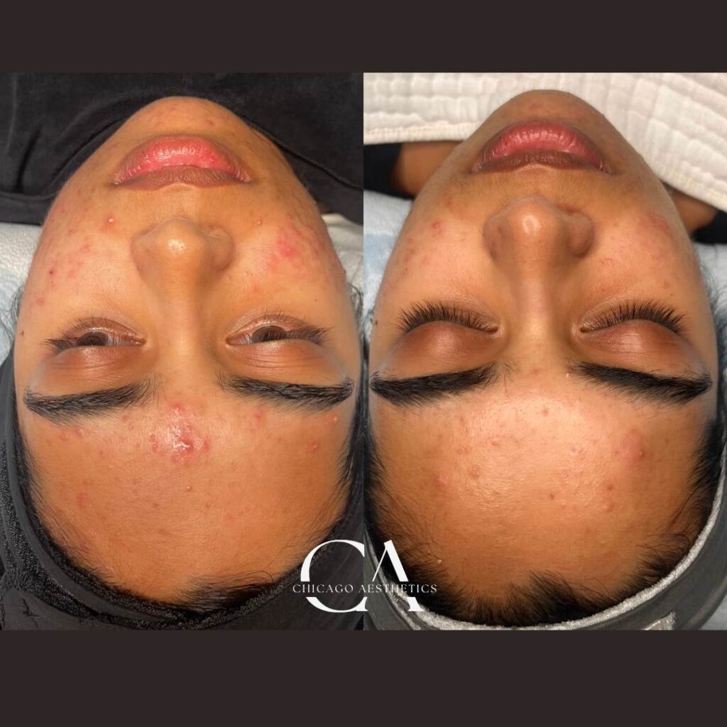 Hydrafacial & Benefits | Chicago Aesthetics Med Spa