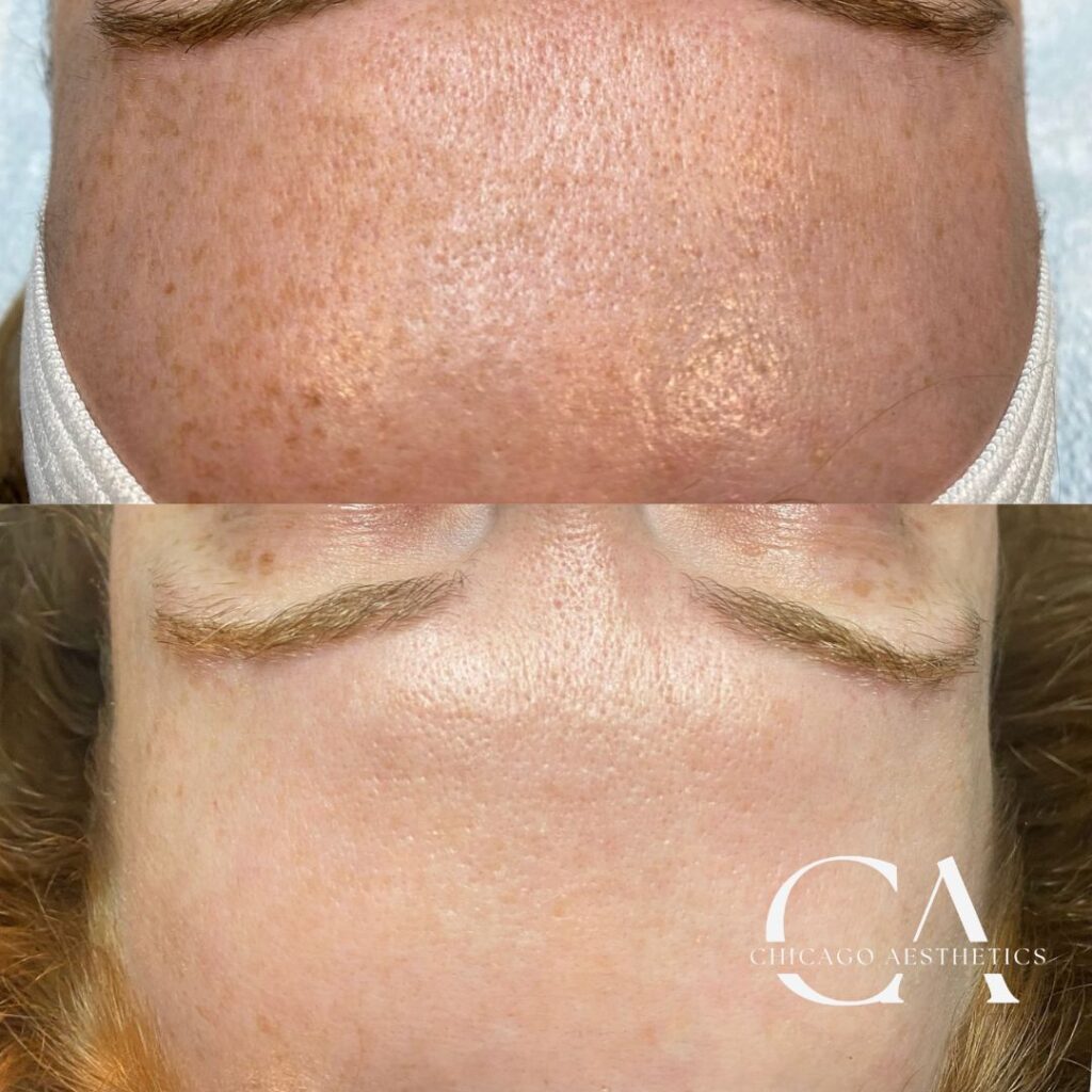 IPL Intense Pulsed Light Treatment | Chicago Aesthetics