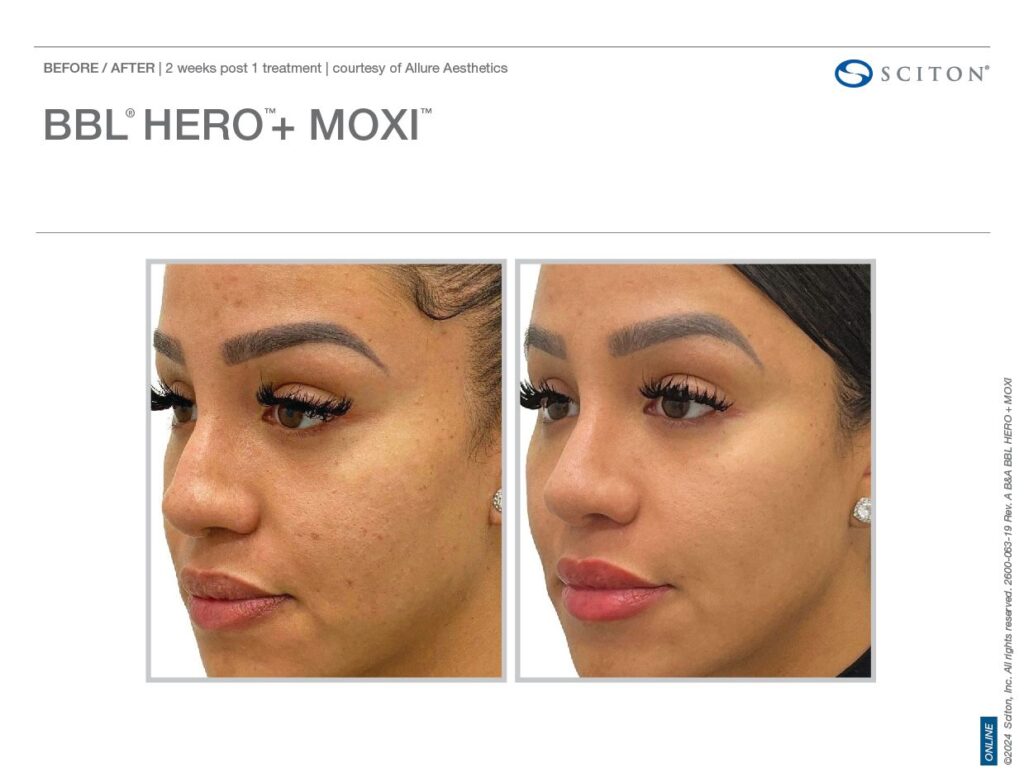 BBL® HEROic™ Laser Treatment | Chicago Aesthetic Surgery & Med Spa