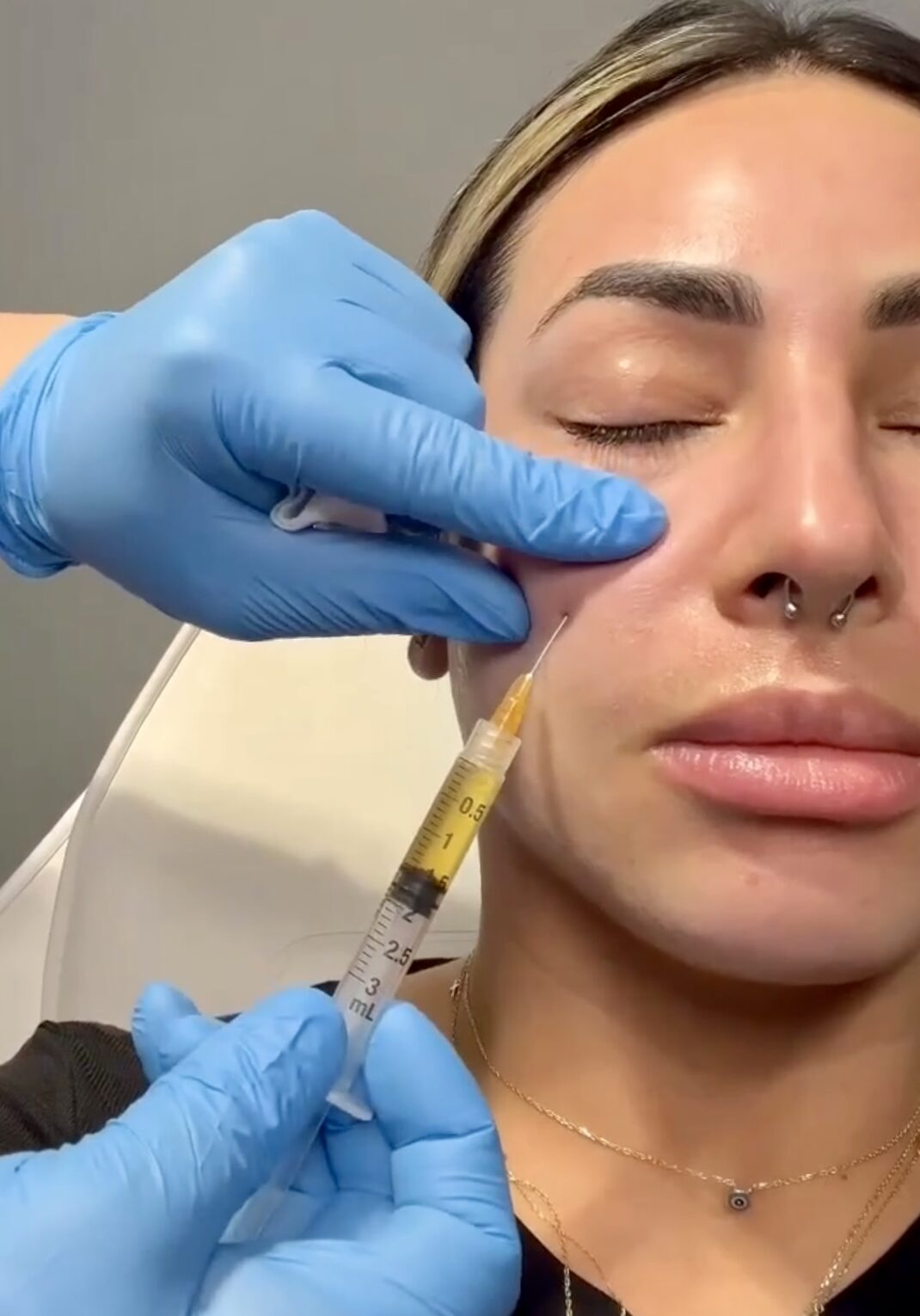 PRP Platelet Rich Plasma Treatment | Chicago Aesthetics Med Spa